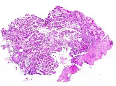 Non-erosive reflux disease rather than cervical inlet patch involves ...