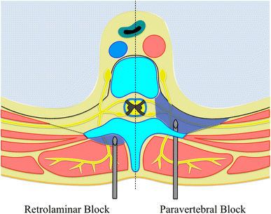 Retrolaminar block: analgesic efficacy and safety evaluation | SpringerLink