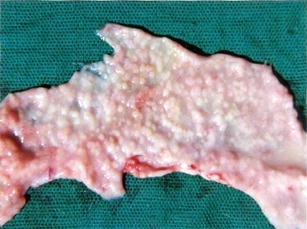 Pathologic lesions of naturally occurring coccidiosis in sheep and ...