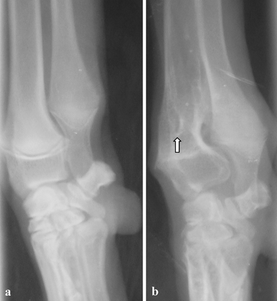 Unilateral premature closure of distal radial growth plate due to ...