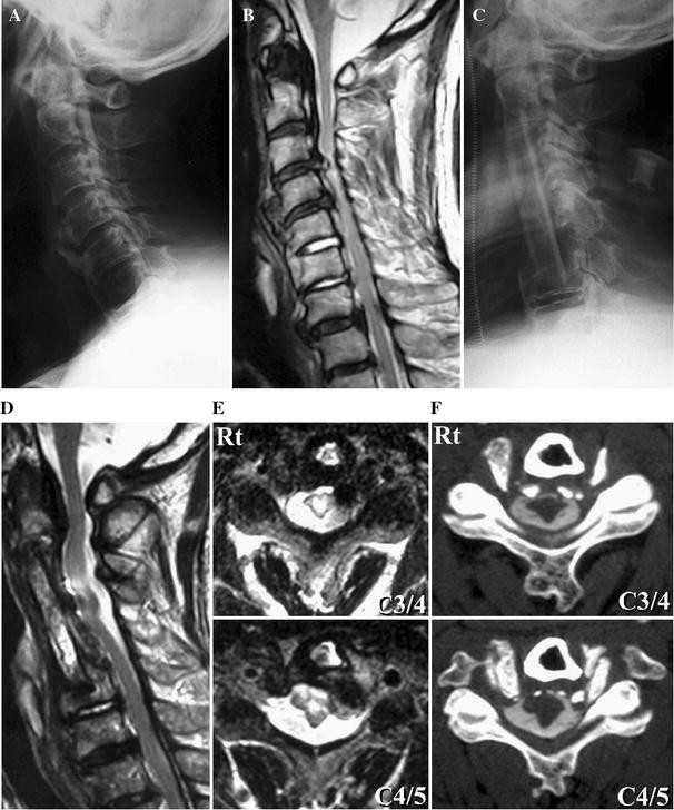 C5 palsy following anterior decompression and spinal fusion for ...