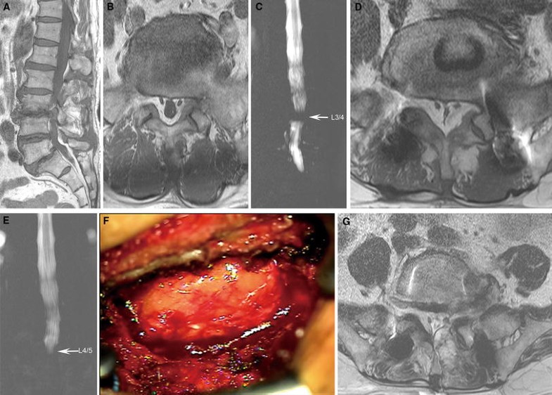 Rapid progression of spinal epidural lipomatosis | SpringerLink
