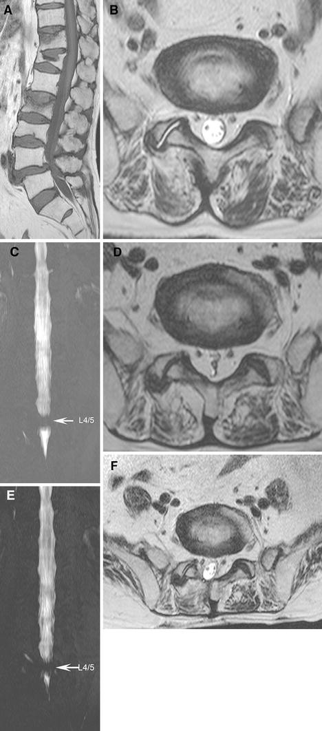 Rapid progression of spinal epidural lipomatosis | SpringerLink