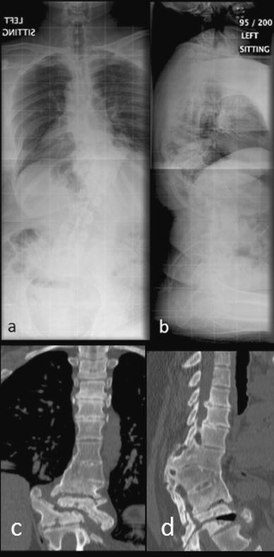 Asymmetric osteotomy of the spine for coronal imbalance: a technical ...