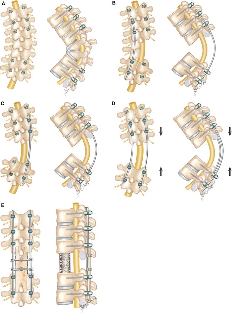 Osteotomies/spinal column resections in adult deformity | SpringerLink