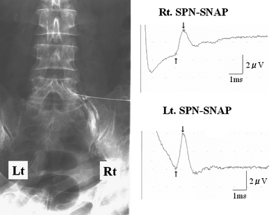 Electrophysiological diagnosis using sensory nerve action potential for ...