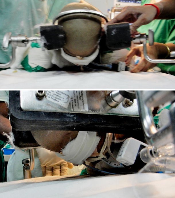 Modified prone position using lateral brace attachments for cervico ...