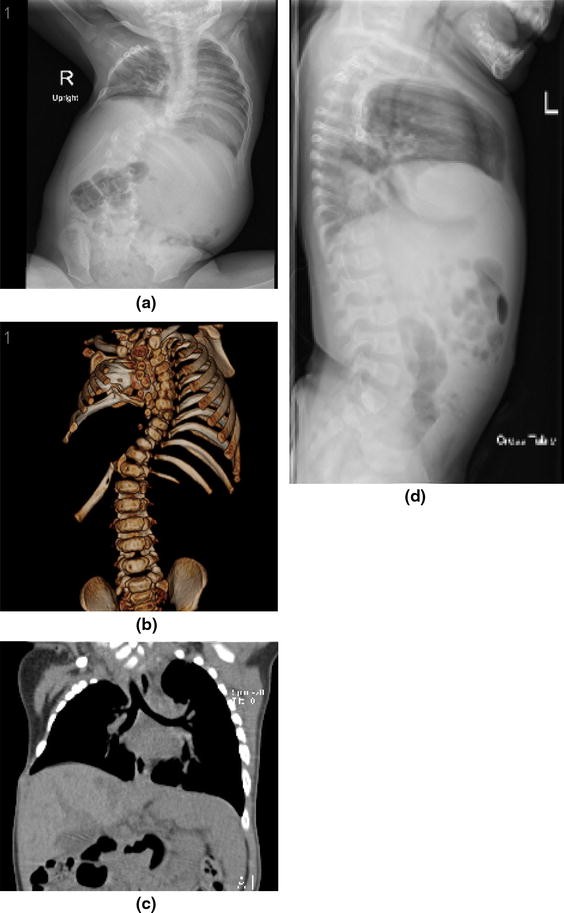 VEPTR: past experience and the future of VEPTR principles | SpringerLink