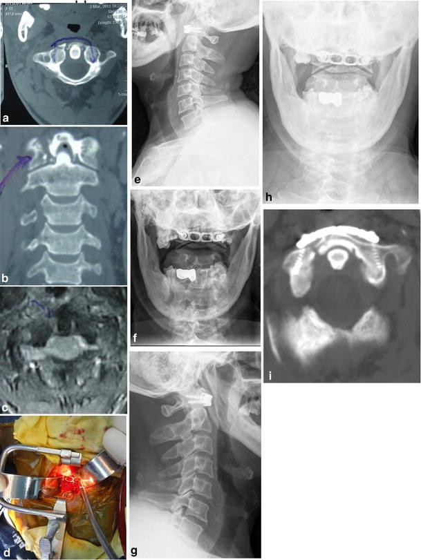 Unstable atlas fracture treatment by anterior plate C1-ring ...