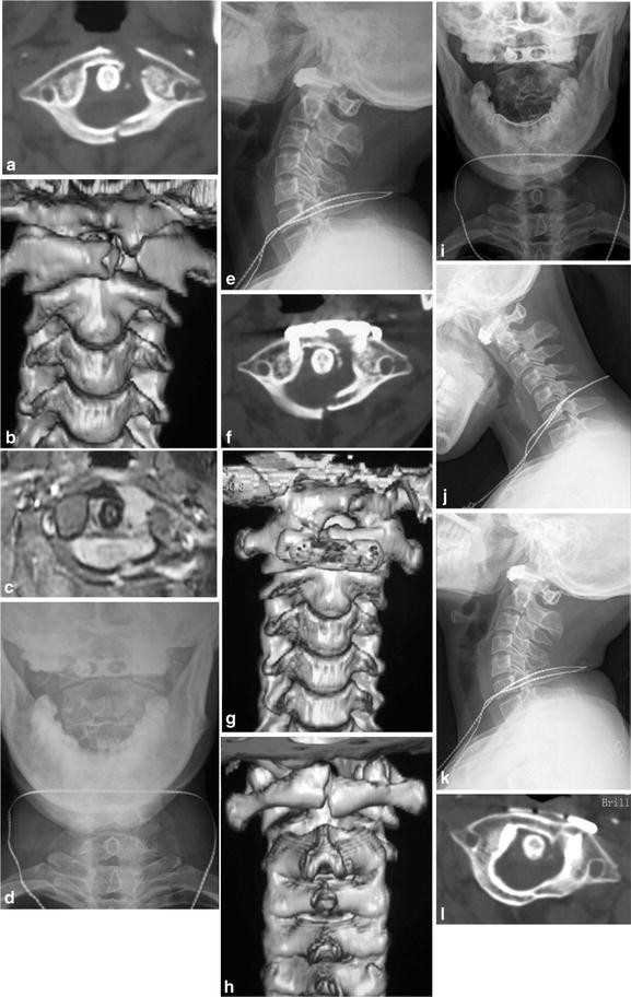 Unstable atlas fracture treatment by anterior plate C1-ring ...