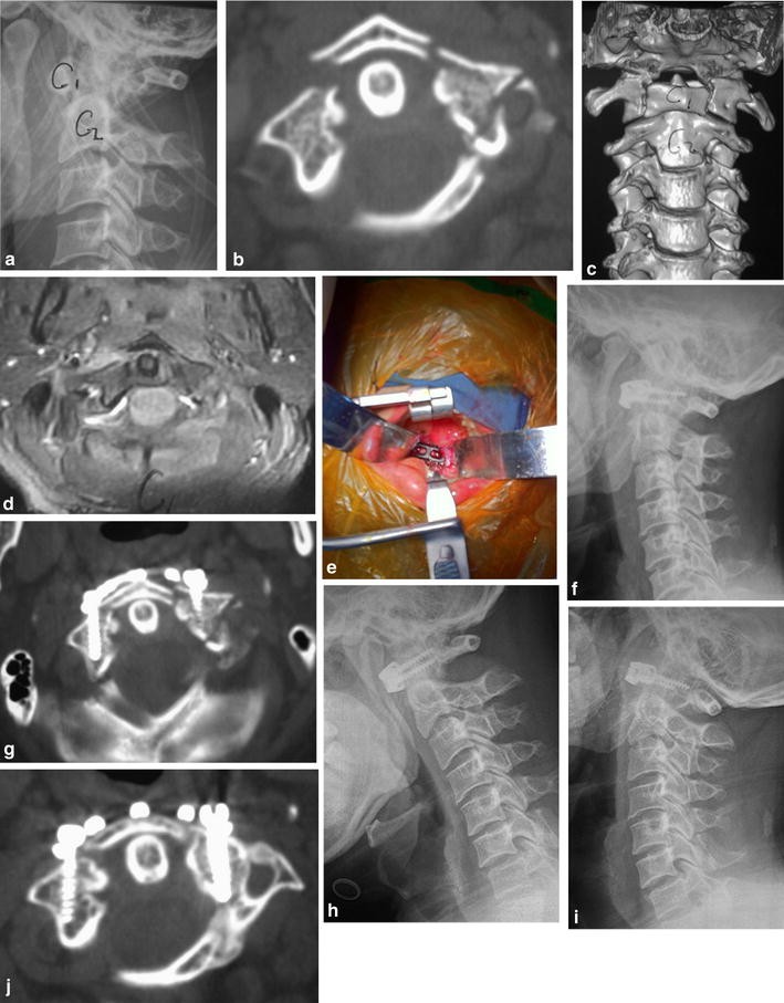 Unstable atlas fracture treatment by anterior plate C1-ring ...