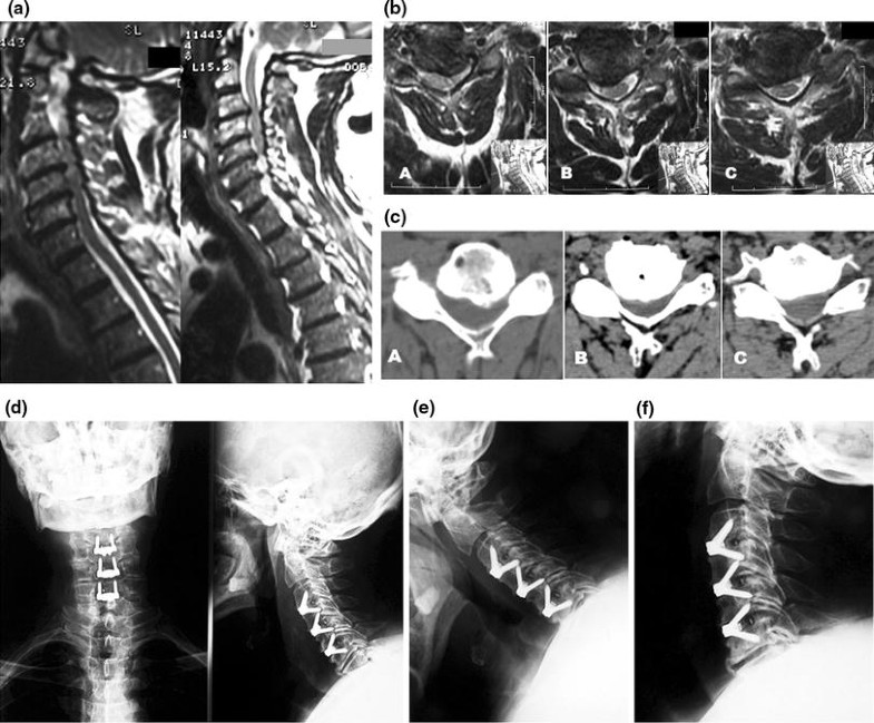 Zero-P: a new zero-profile cage-plate device for single and multilevel ...