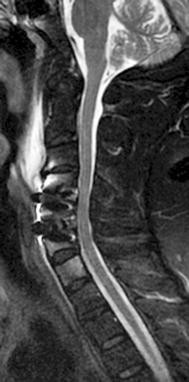 Zero-P: a new zero-profile cage-plate device for single and multilevel ...