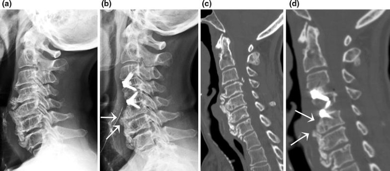 Zero-P: a new zero-profile cage-plate device for single and multilevel ...