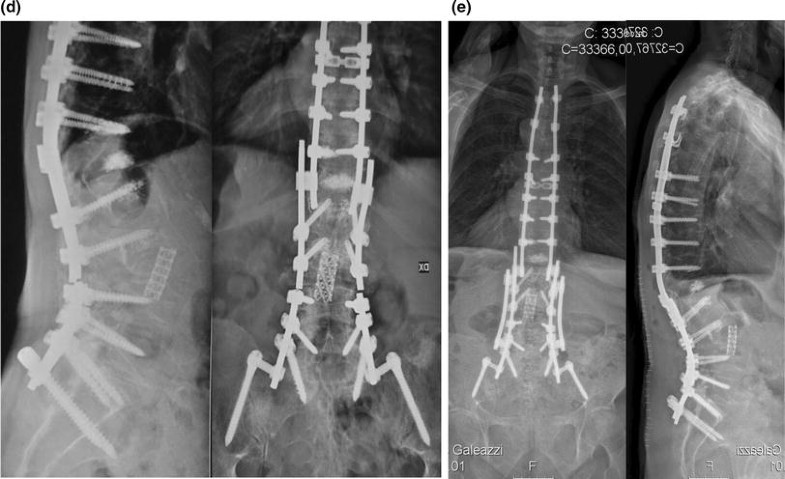 Revision surgery after PSO failure with rod breakage: a comparison of ...