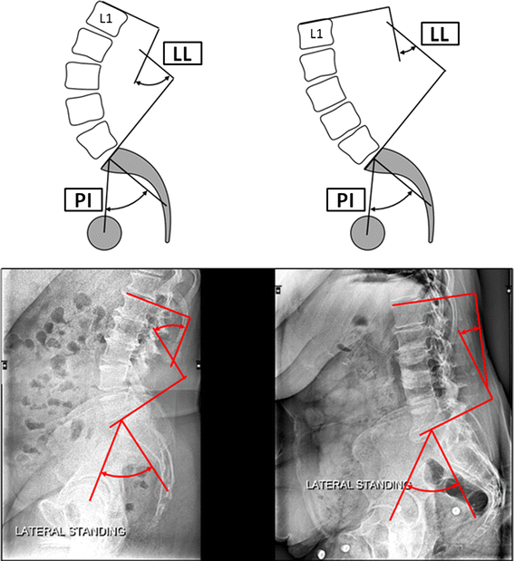 Sagittal deformities of the spine: factors influencing the outcomes and ...