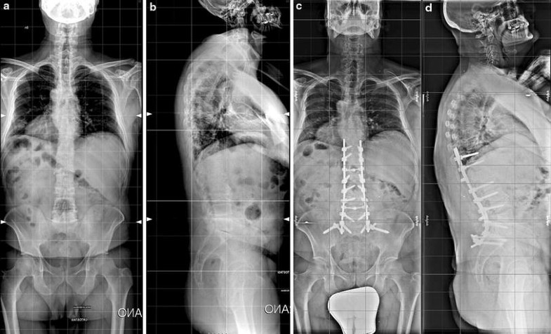 Pedicle subtraction osteotomies (PSO) in the lumbar spine for sagittal ...