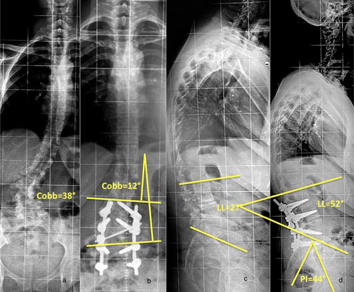 Pedicle subtraction osteotomies (PSO) in the lumbar spine for sagittal ...