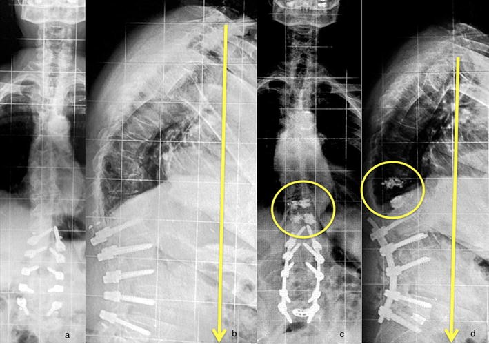 Pedicle subtraction osteotomies (PSO) in the lumbar spine for sagittal ...