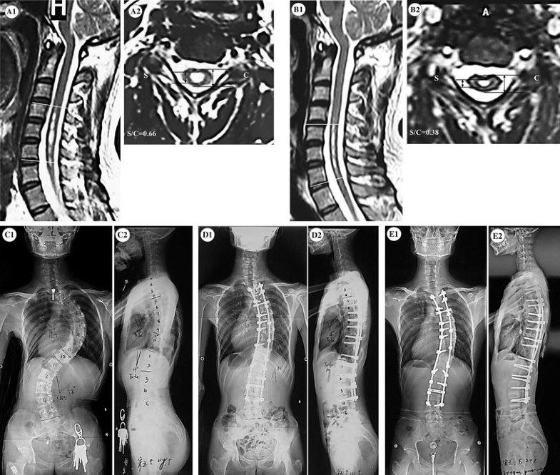 Evolution of syrinx in patients undergoing posterior correction for ...