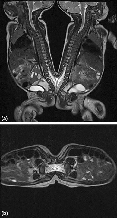 Surgical management of pygopagus conjoined twins with spinal bifida ...