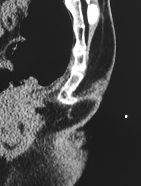 Coccygectomy for coccygeal spicule: a study of 33 cases | SpringerLink