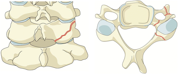 AOSpine subaxial cervical spine injury classification system | SpringerLink