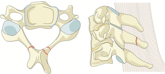AOSpine subaxial cervical spine injury classification system | SpringerLink