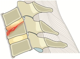 AOSpine subaxial cervical spine injury classification system | SpringerLink