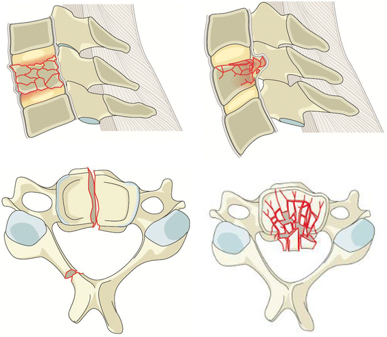 AOSpine subaxial cervical spine injury classification system | SpringerLink