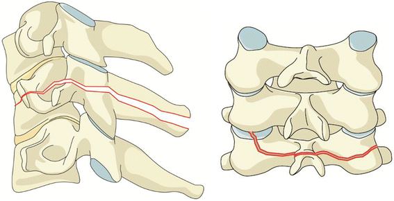 AOSpine subaxial cervical spine injury classification system | SpringerLink