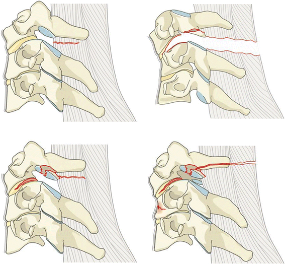 AOSpine subaxial cervical spine injury classification system | SpringerLink