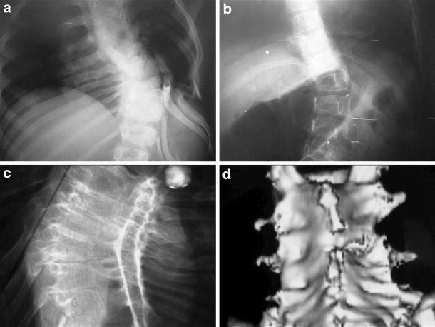 Vertebral, rib, and intraspinal anomalies in congenital scoliosis: a ...