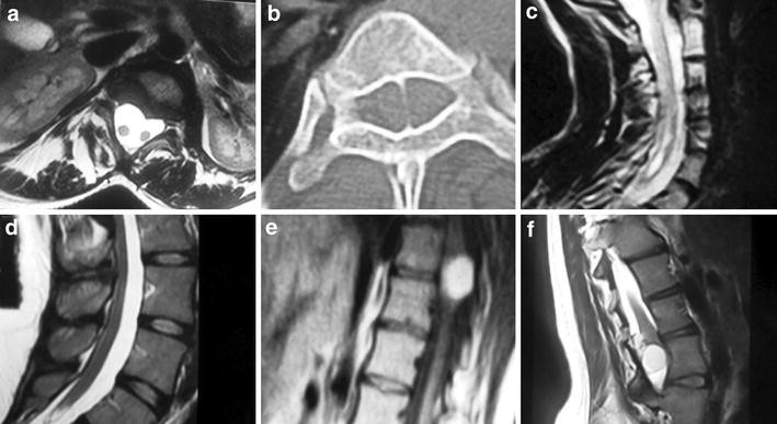 Vertebral, rib, and intraspinal anomalies in congenital scoliosis: a ...