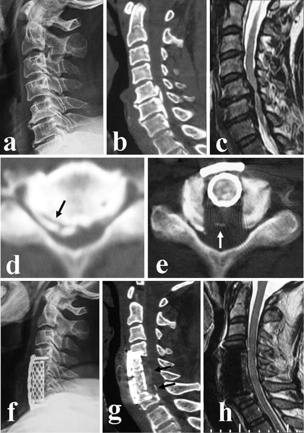 Implications of different patterns of “double-layer sign” in cervical ...