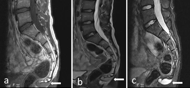 A rare cause of recalcitrant coccydynia: benign dermoid cyst ...