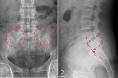 Normative values for the L5 incidence in a subgroup of transitional ...
