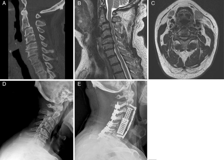 A cohort study of the morbidity of combined anterior-posterior cervical ...