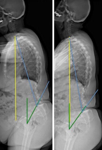 Global tilt: a single parameter incorporating spinal and pelvic ...