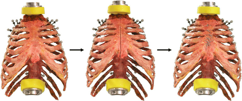EUROSPINE 2016 FULL PAPER AWARD: Wire cerclage can restore the ...