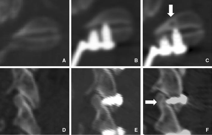 Optimal area of lateral mass mini-screws implanted in plated cervical ...