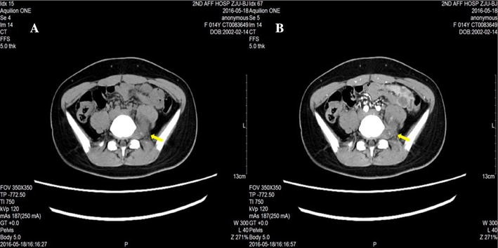 Malignant peripheral nerve sheath tumor in the paraspinal region ...