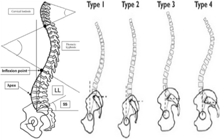 Classification of normal sagittal spine alignment: refounding the ...
