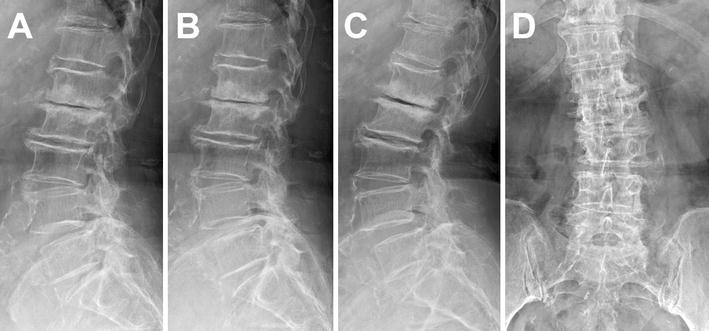 Low back pain due to middle cluneal nerve entrapment neuropathy ...