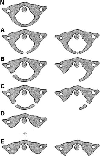 The prevalence of congenital C1 arch anomalies | SpringerLink