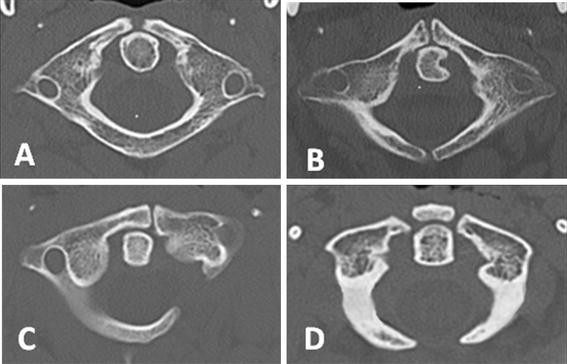 The prevalence of congenital C1 arch anomalies | SpringerLink