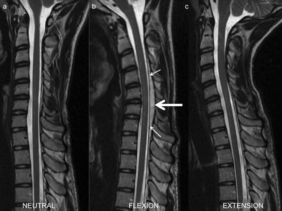 Hirayama disease | SpringerLink