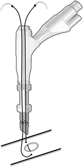 Iatrogenic dural tear in endoscopic lumbar spinal surgery: full ...