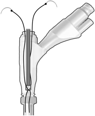 Iatrogenic dural tear in endoscopic lumbar spinal surgery: full ...