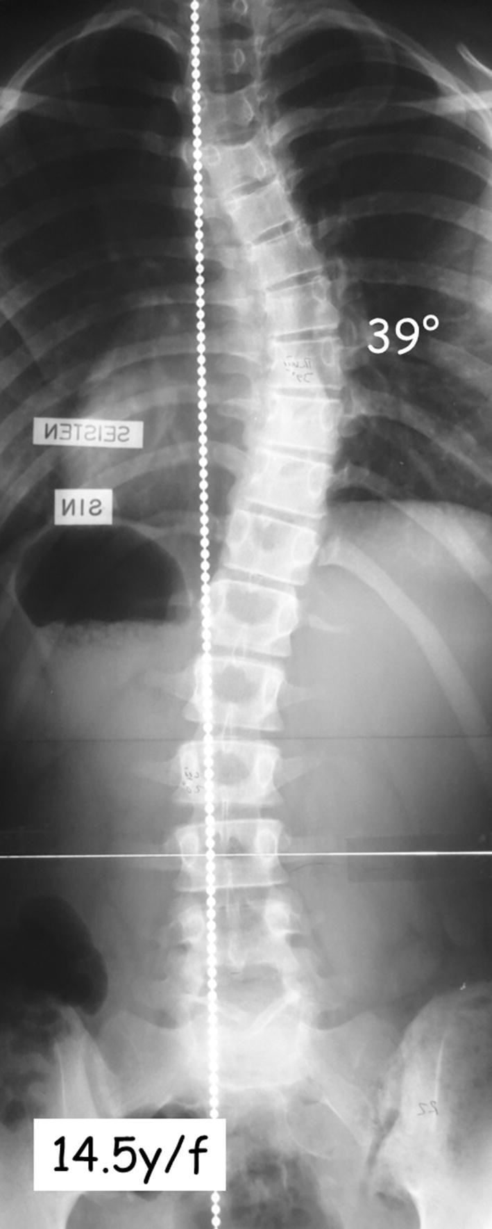 Concomitant low-grade isthmic L5-spondylolisthesis does not affect the ...